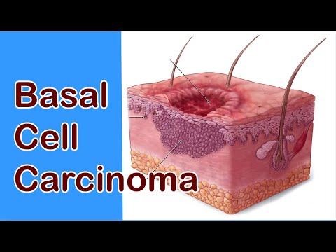 Basal Cell Carcinoma: Not the Most Deadly, but is Certainly the Most Destructive Form of Skin Cancer
