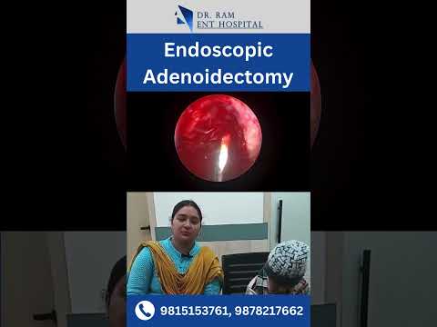 🎥 Endoscopic Adenoidectomy | Performed by Dr. Ram Kumar | Dr. Ram ENT Hospital, Ropar 🎥