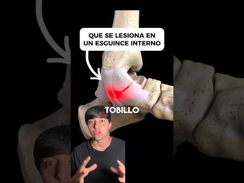 Cómo es un esguince interno en el tobillo y qué consecuencias tiene