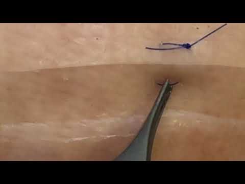 SUTURE REMOVAL - MATTRESS