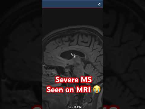 Severe MS seen on MRI 😭