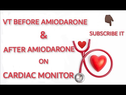 VT BEFORE AND AFTER AMIODARONE..