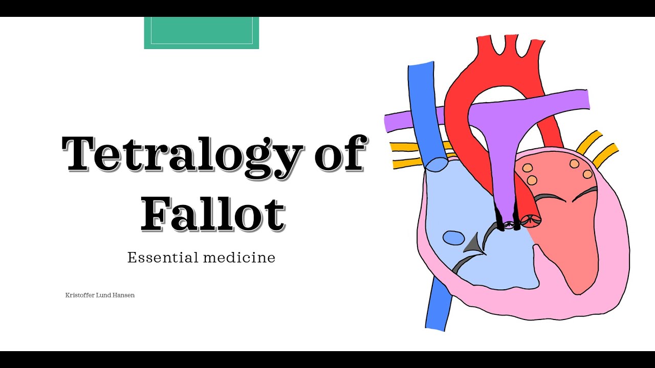 Tetralogy of Fallot [Essential medicine]