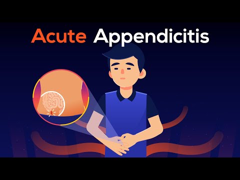 What is Appendicitis? A real case of Burst Appendix.