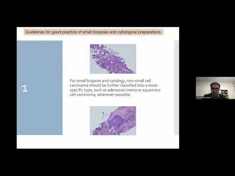 Mi interpretación de la biopsia pulmonar - Dr. Cristian Ortiz Villalón