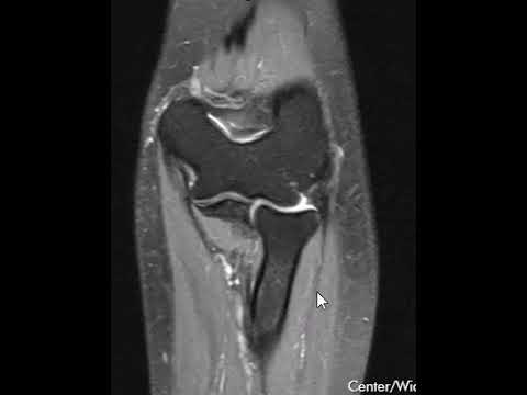 Lateral epicondylitis of elbow