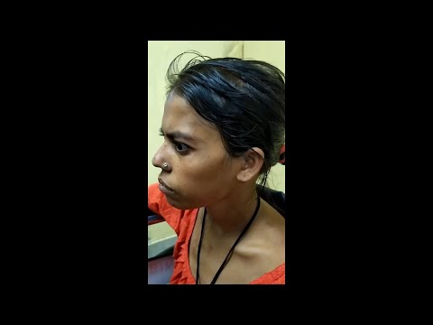 Jaw Muscle Twitching in a Neurologic-Rheumatologic Overlap Syndrome