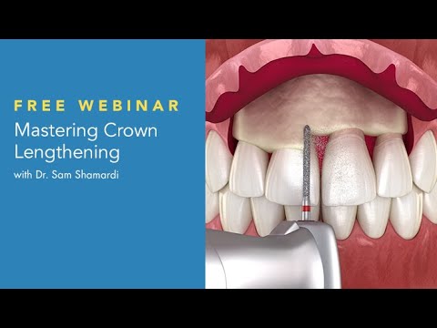 Dental Treatment: Functional Crown Lengthening May 10, 2021