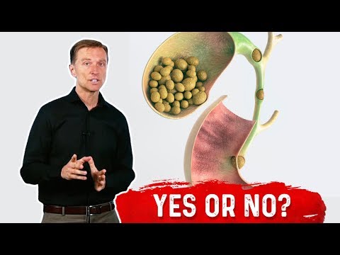 Should I Remove My Gallbladder If I have Stones? – Dr.Berg