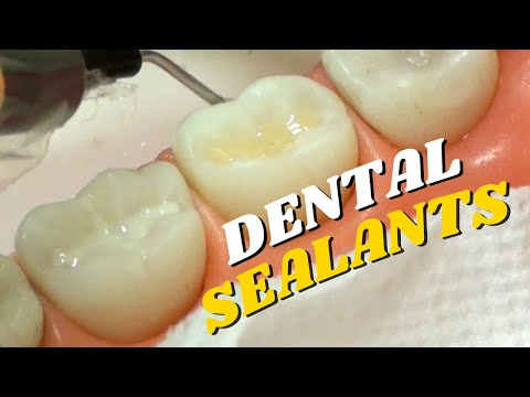 How to Apply Dental Sealants: Step by Step Procedure | In Office to Hands On Dental Training