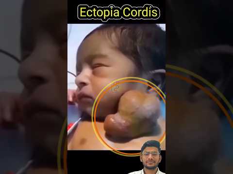 Ectopia Cordis 😱...#Ectopiacordis #youtubeshorts#youtubeshorts#doctor#heart #hearthealth#heartbreak