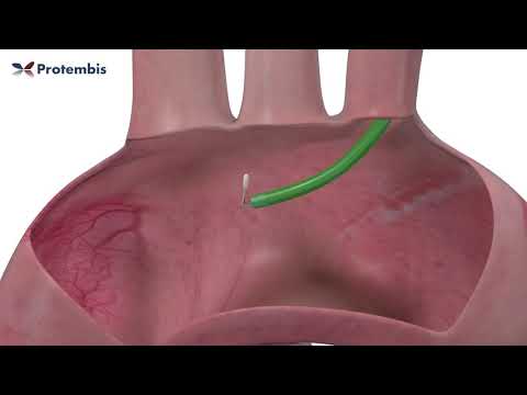 Protembis - Overview
