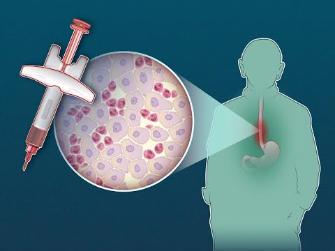 Dupilumab for Eosinophilic Esophagitis | NEJM