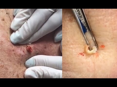 Removal of an Epidermal Cysts - Best Pimple Poppers!