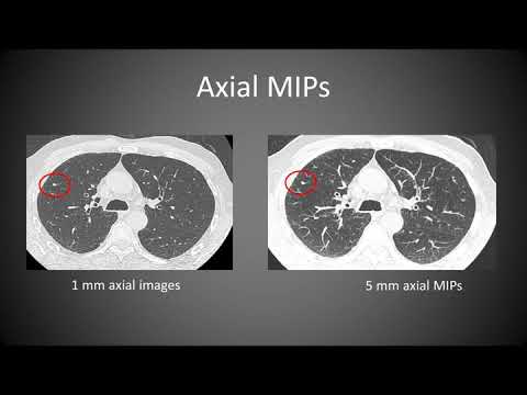 Imaging Lung cancer screening