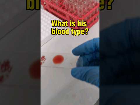 What is his blood type? #laboratory #bloodtest #cls #mls #medtechstudent #bloodtype #bloodgroup