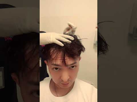 PRP hair treatment @GSM medical center satwa Dubai