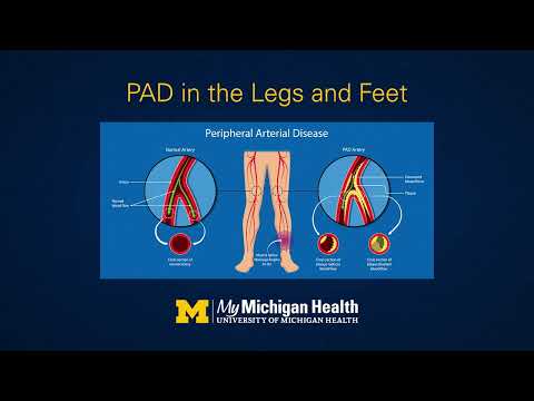 Understanding Your Risk of PAD and Heart Disease