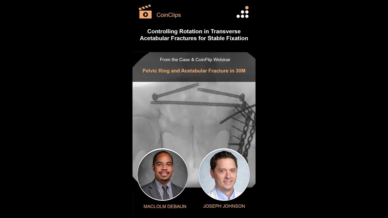Controlling Rotation in Transverse Acetabular Fractures for Stable Fixation