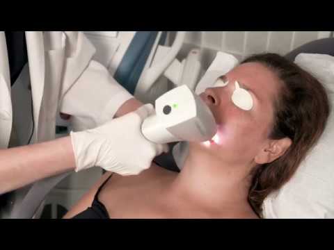 M22 Q-Switched Patient Treatment #3 | Lumenis