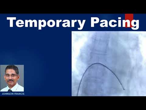 Pacing Lead - Cardiac Pacing Leads Latest Price, Manufacturers & Suppliers