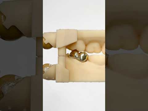 14Kt Gold Crown @EnvisiontecMain #envisiontec #lsk121shorts #dentist #teeth