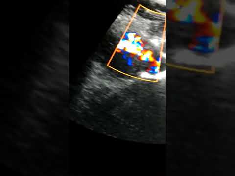 AV Malformation in uterus RPOC