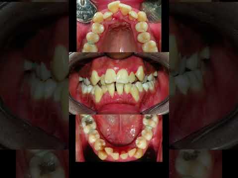 Braces for severe crowding teeth.