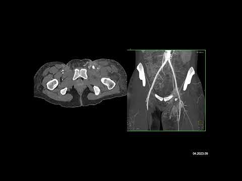 In this patient with IVDA the most likely diagnosis is? #radiology