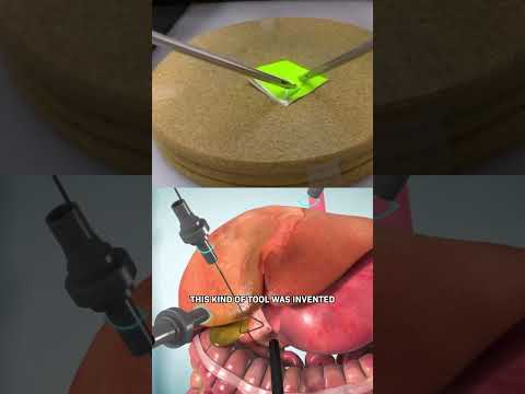 How Laparoscopic Surgery Works