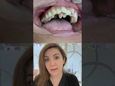 Supernumerary Or Extraordinary Teeth?!