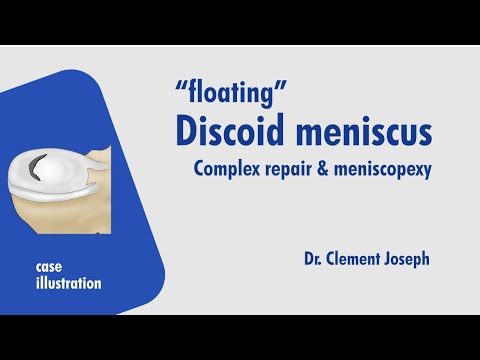 Discoid meniscus with anterior detachment complex repair