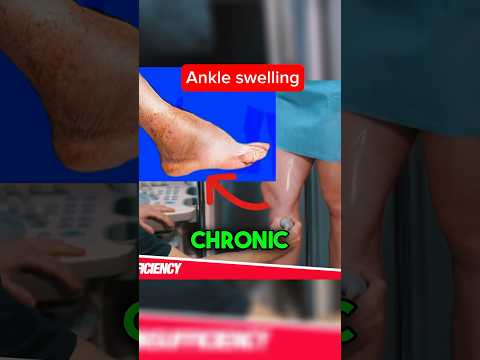 Chronic Venous Insufficiency