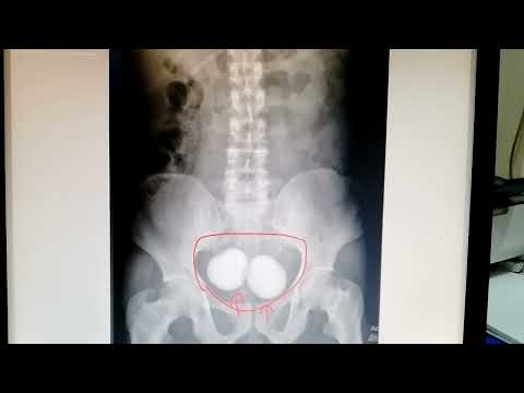 What is this see the kub xray.  #xray#subscribe 🙏🙏🙏 #health  #viralvideo #urineanalysis#doctor
