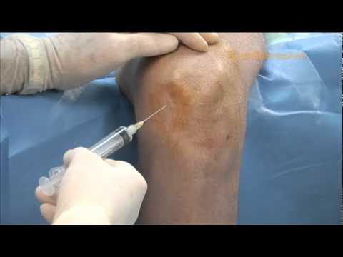 Infiltration Intra Articulaire Du Genou Voie Antérieure Knee