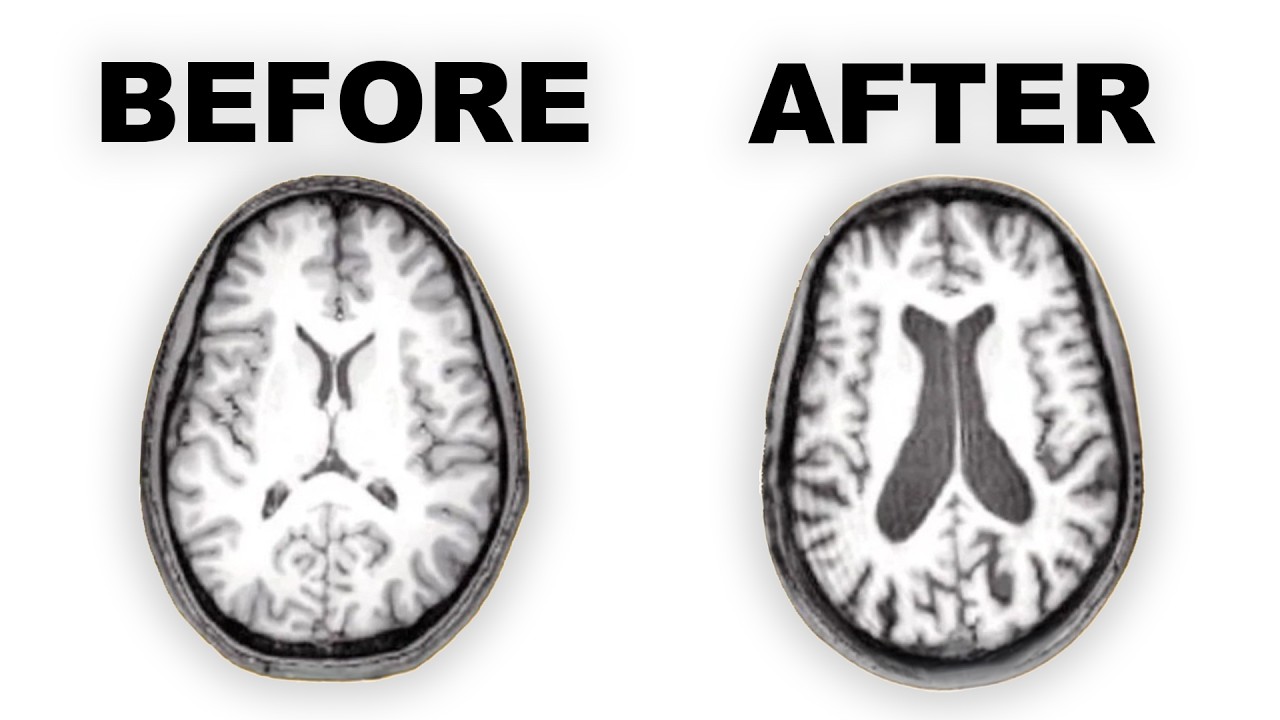 Exploring the Long-term Effects of Antipsychotics on Brain Health ...