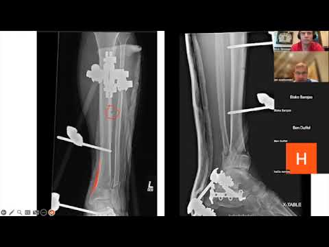 Pilon Fracture Case Example.