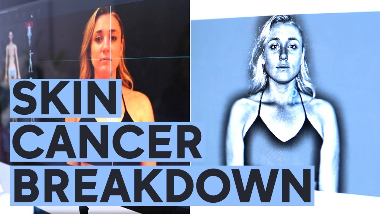 Skin cancer prevention and detection with new mole-mapping device | Glam Lab