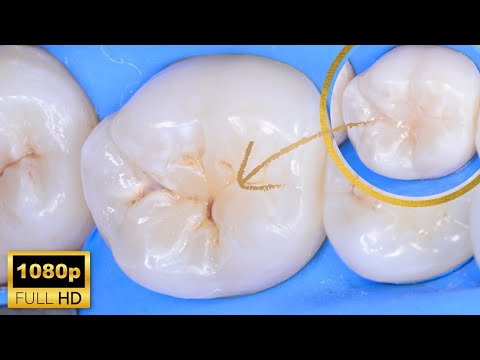 AWESOME Dental Sealant Procedure in HIGH DEF