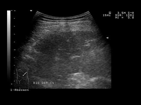 Dynamic air bronchogram