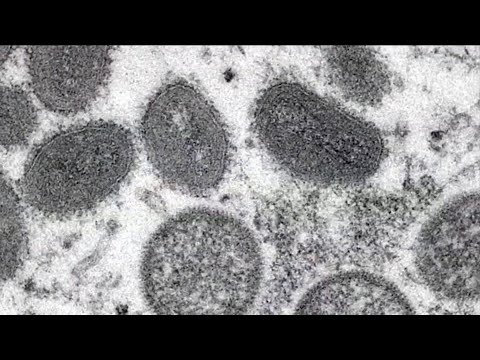 Presumptive case of monkeypox probed in South Florida