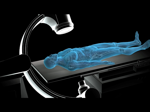 Non Cardiac Percutaneous Transluminal Angioplasty | NCPTA | Nucleus Health
