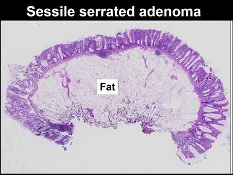 Serrated polyps Learn to tell the difference between hyperplastic polyp and sessile serrated lesion