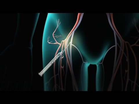 Catheter Ablation