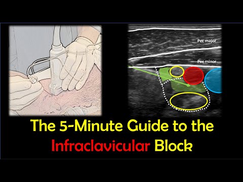 Infraclavicular Brachial Plexus Block - a "How-To" Guide