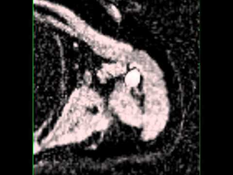 Conventional Chondrosarcoma, Humerus