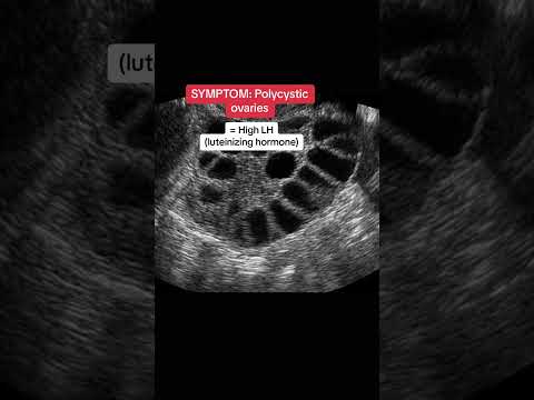 What your SYMPTOMS say about your PCOS