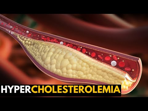 Hypercholesterolemia Everything You Need to Know