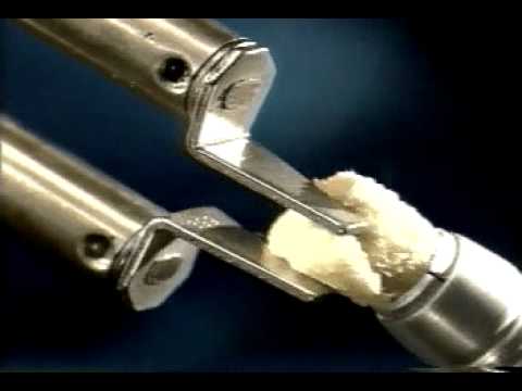 SOT Removal
