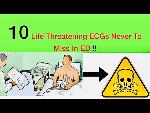10 Life-threatening ECGs Never To Miss In ED: Deadly ECG Patterns-Part 1
